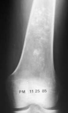 Chondrosarcoma - Pathology - Orthobullets